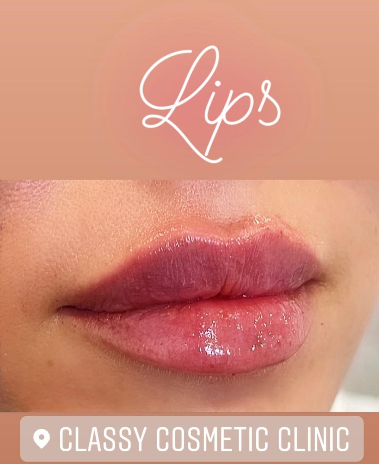 Dermal Fillers And Facial Transformation - Classy Cosmetic Clinic