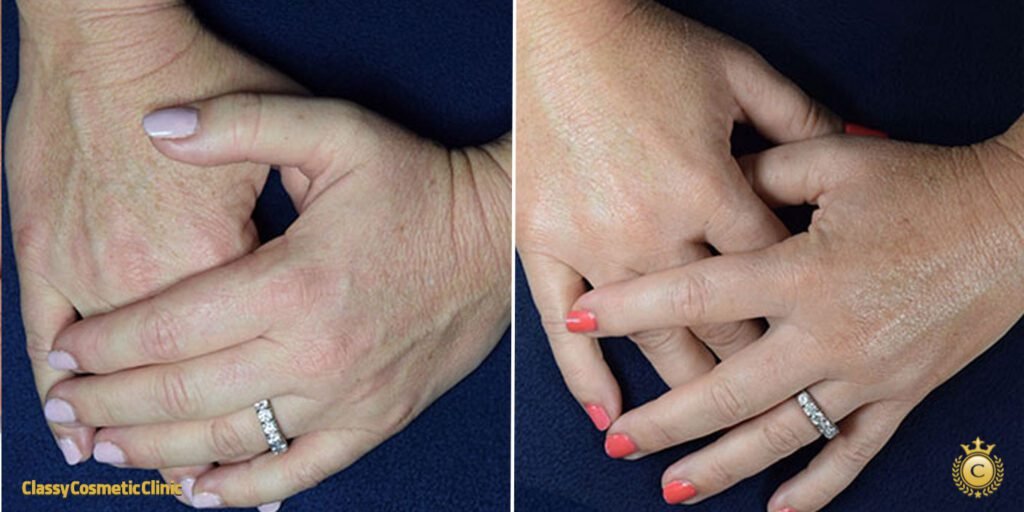 Hand Rejuvenation with Filler Injections: The Complete Guide