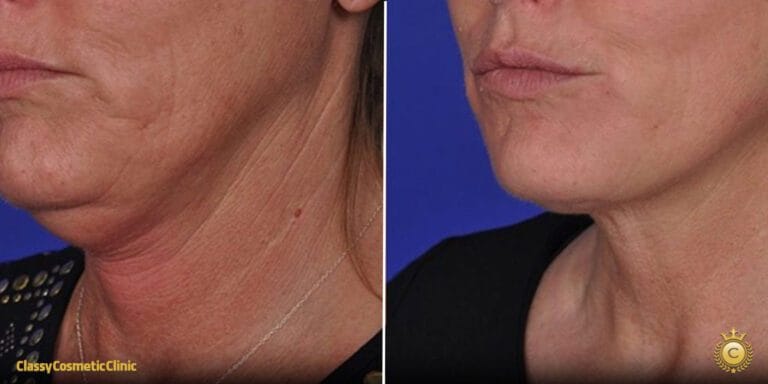 How to Tighten Neck Skin Without Surgery: Effective Ways
