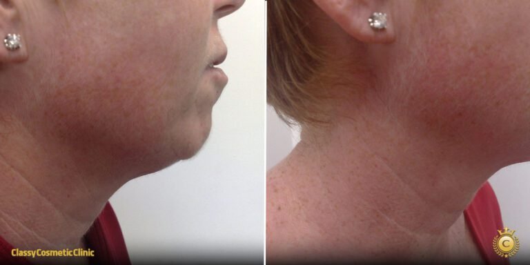 How to Tighten Neck Skin Without Surgery: Effective Ways