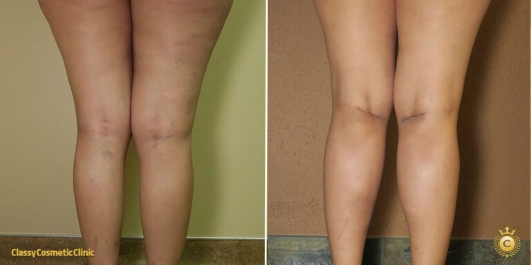 Guide to Calf Filler Injections Near Me In Markham Toronto