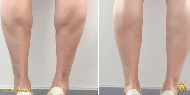 Guide to Calf Filler Injections Near Me In Markham Toronto