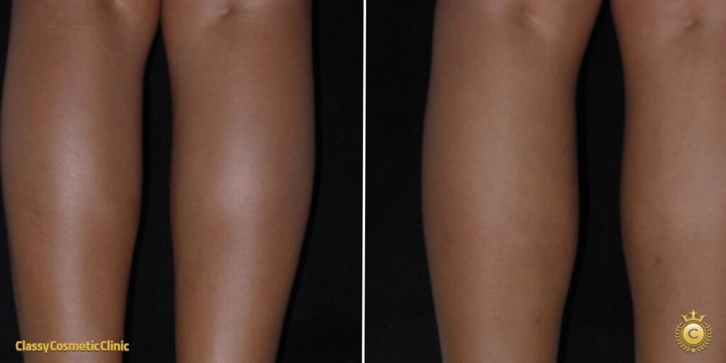 Guide to Calf Filler Injections Near Me In Markham Toronto