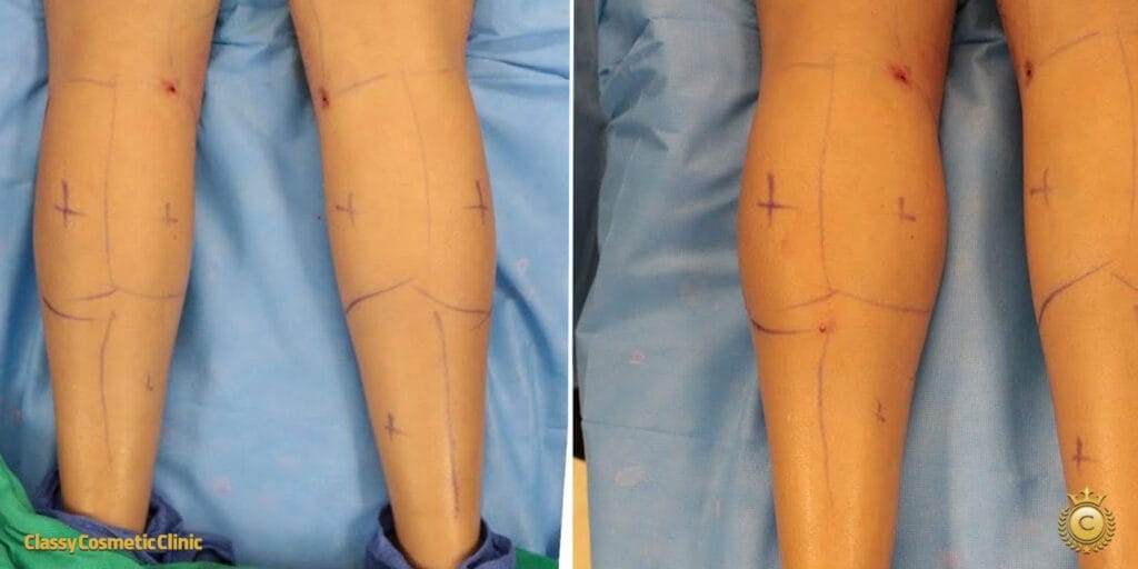 Guide to Calf Filler Injections Near Me In Markham Toronto