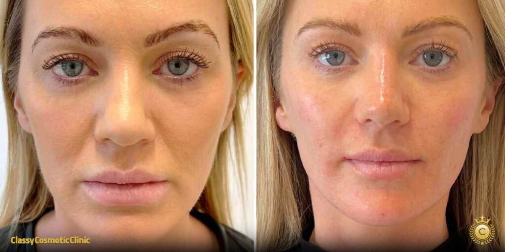 Full Face Filler 101 Near Me: No Surgery Balance and Beauty