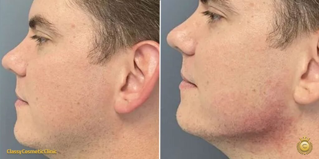 Jawline Filler 101: Comprehensive Guide to Benefits and Cost