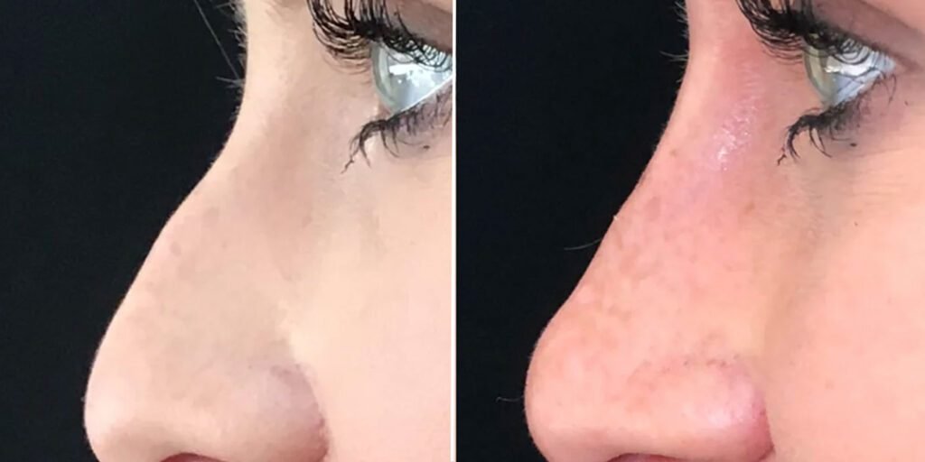 Nose filler Injection 101: Comprehensive Guide to Beauty