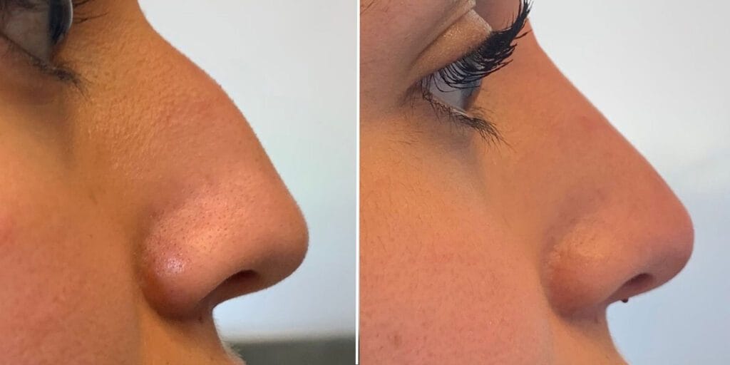 Nose filler Injection 101: Comprehensive Guide to Beauty