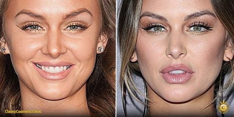 Smile Line Filler Injections 101: Benefits, and Right Filler