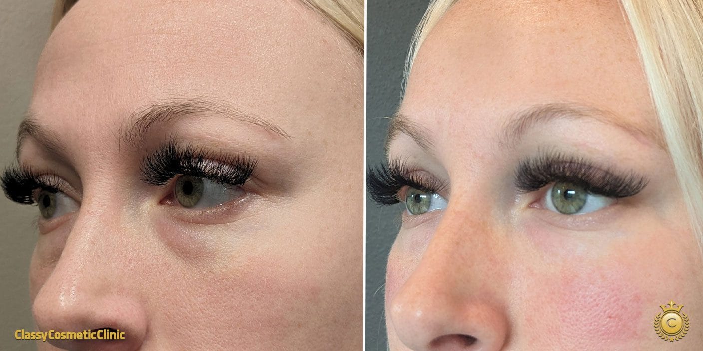 Under Eyes Filler 101 Benefits And Expectations Full Guide