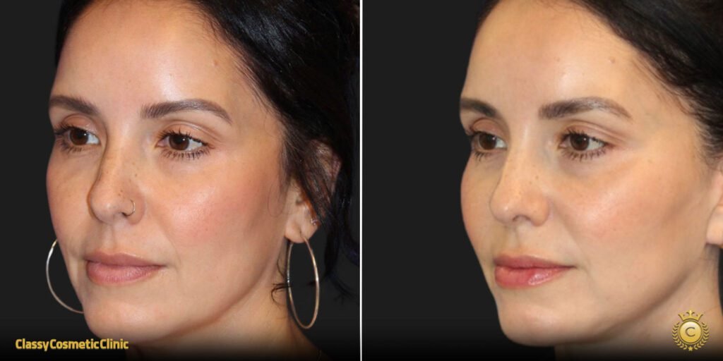 Facelifts for 40 Year Olds: Achieve a Youthful Look