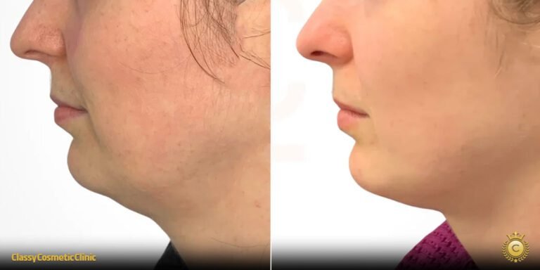 Fat Burning Injection: Benefits and Procedure