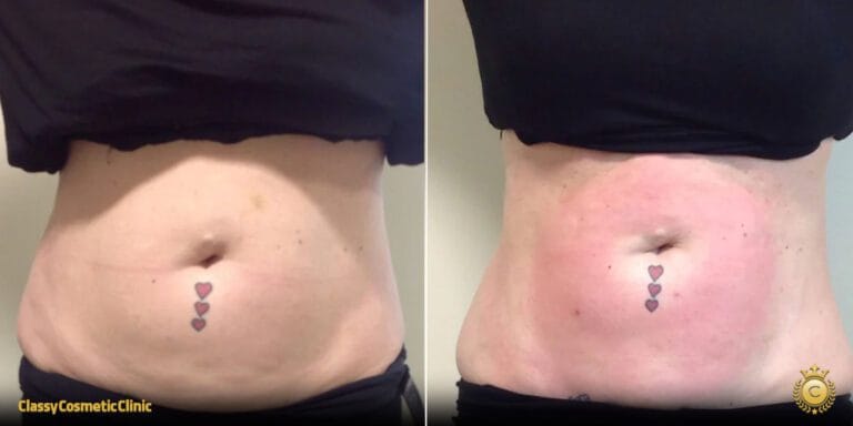 Fat Burning Injection: Benefits and Procedure