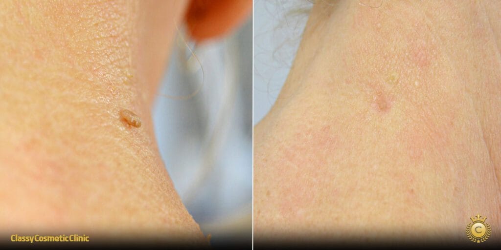 Essential Oils for Skin Tag Removal: Natural Solutions