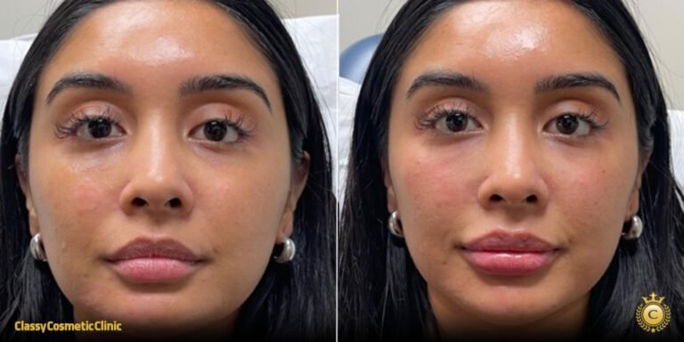 Can You Feel Filler in Your Face: Filler Injections Near Me