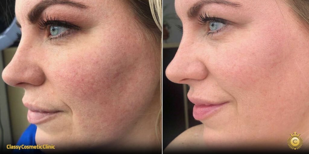 Lifting Face Treatment Explained: Path to a Youthful Look