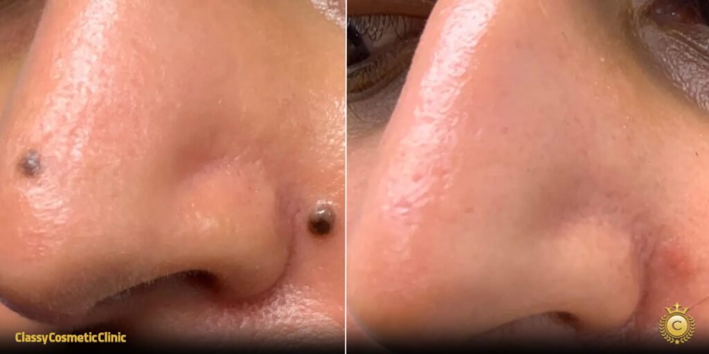 How to Get Rid of Moles on Nose: Home and Clinical Solutions