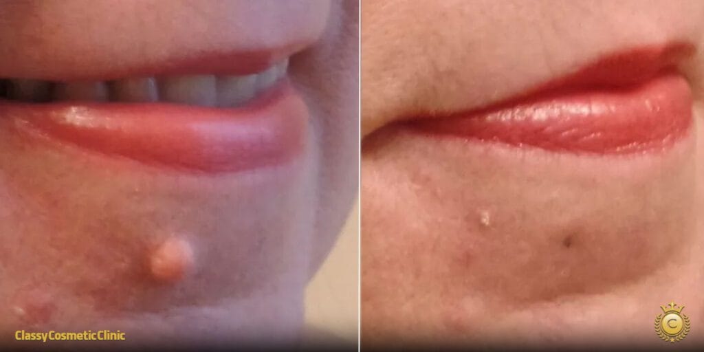 Get Rid of Moles on Your Face Forever: Long-Lasting Methods