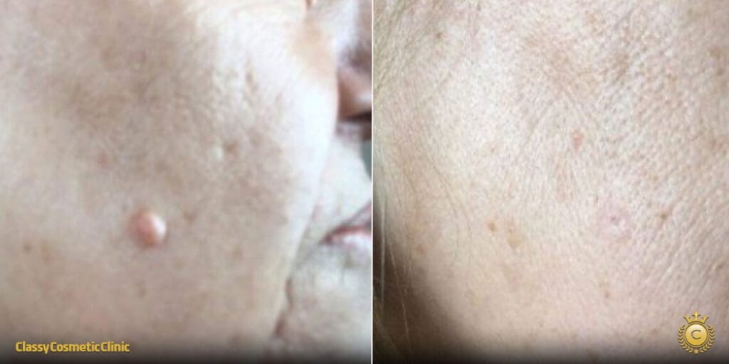 Get Rid of Moles on Your Face Forever: Long-Lasting Methods