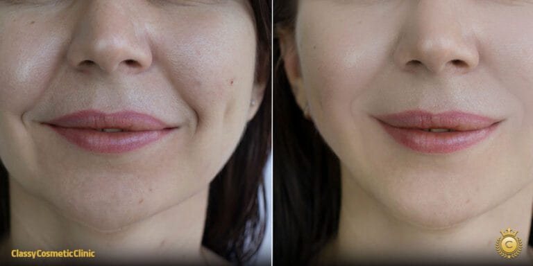 Smile Line Filler Benefits Near Me In Markham, Toronto