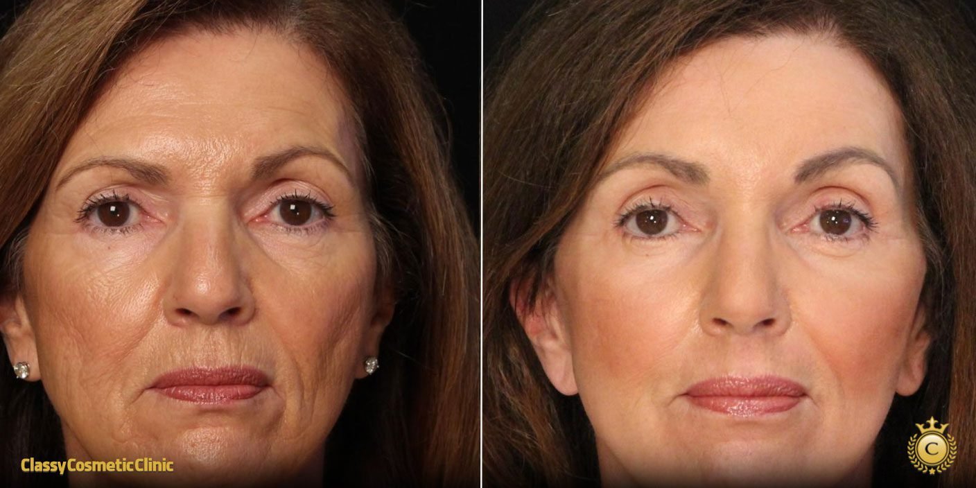 Are Deep Wrinkle Treatments Safe for Long-Term Use?