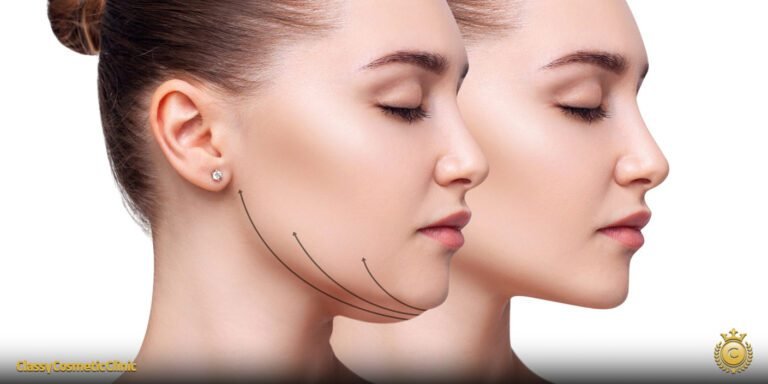 Double Chin Fat Dissolving Injections: Markham, Toronto