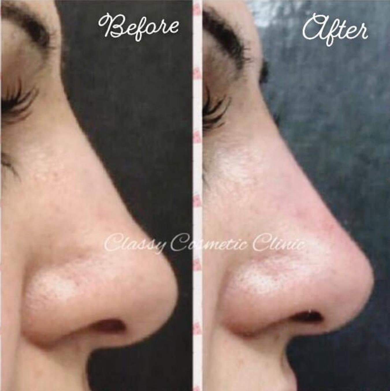 Fillers, Botox, Rejuvenation and PRP Photo and Video Gallery
