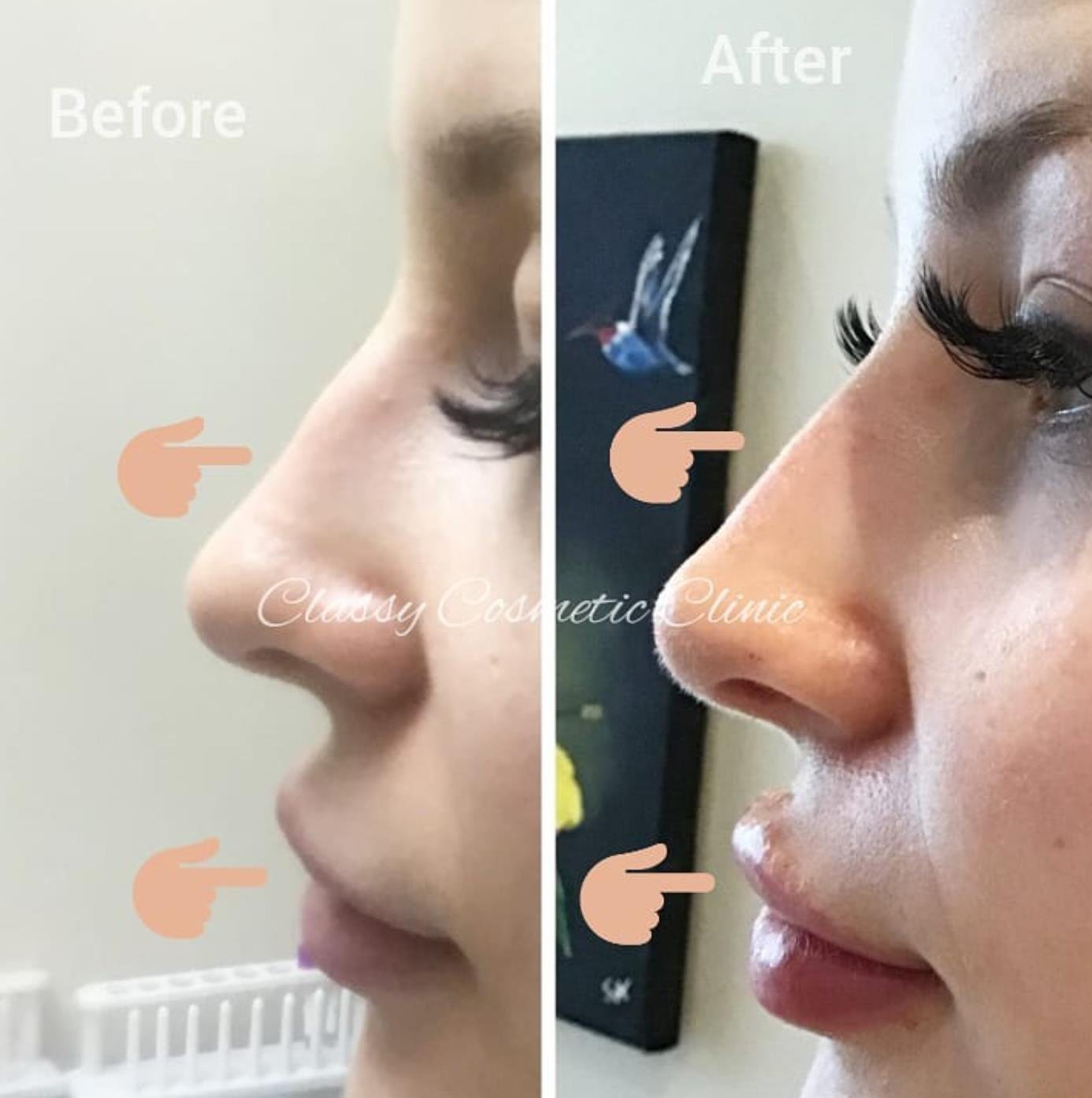 Fillers, Botox, Rejuvenation and PRP Photo and Video Gallery