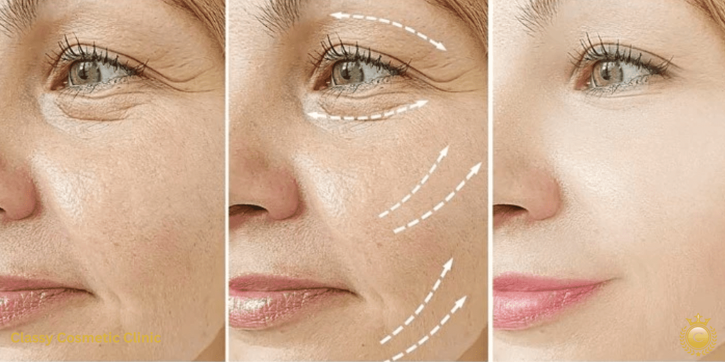 What Is Jalupro? The Skin Booster Treatments in Markham 101